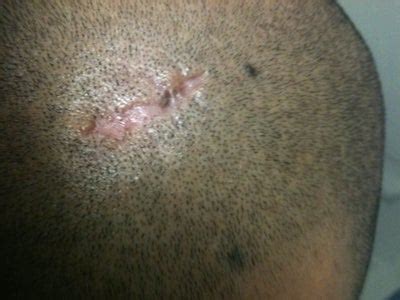 Will My Hair Grow Back After Getting Scalp Cysts Surgically Removed Photo Doctor Answers Tips
