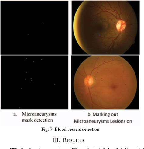 Figure 1 From Automated Microaneurysms Detection In Fundus Images Using