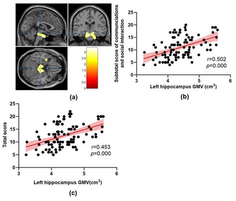 Brain Autism Spectrum Mini Brain Study Reveals Possible Key Link To