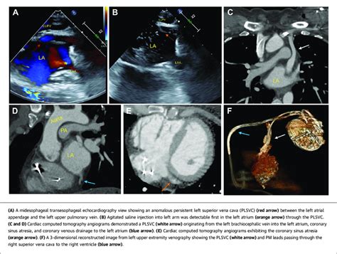 Diagnostic Imaging Modalities Showing The Persistent Left Superior Vena Download Scientific