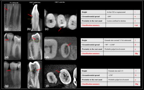 External Cervical Resorption A Three‐dimensional Classification