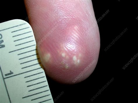Calcinosis Cutis Stock Image C0570580 Science Photo Library