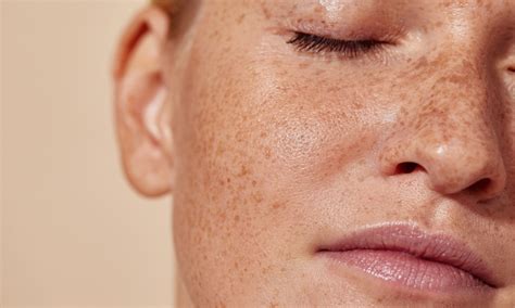 Understanding Freckles Causes Treatments And Prevention Healthcall