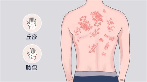 拍照识别皮肤病 皮肤病的症状表现 疾病科普 博禾医生