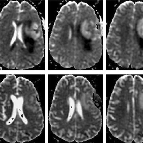 Illustration Of Extracellular Edema Regression The Sets Of Adc Maps At