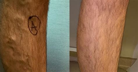 Varis Cerrahisi Varis Nedir Neden Oluşur