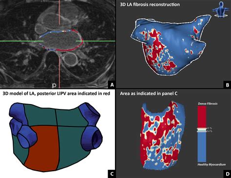 Extent Of Left Atrial Fibrosis Correlates With Descending Aorta
