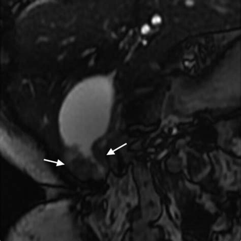 The Bismuth Corlette Classification Of Perihilar Tumors Type 1 Is The Bismuth Corlette Classification Of Perihilar Tumors Type 1 Is