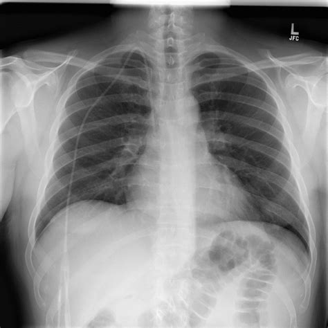 Siim Acr Pneumothorax So Development