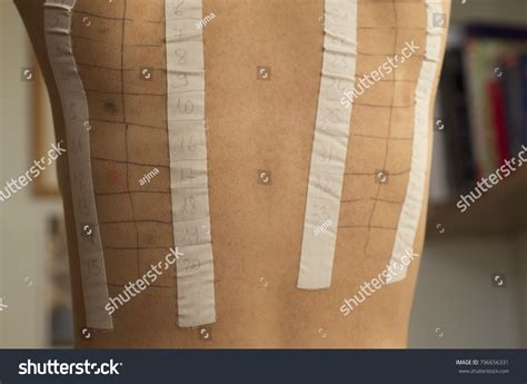 Patch Test Allergic Reaction Allergic Contact Foto Stok 796656331 Shutterstock