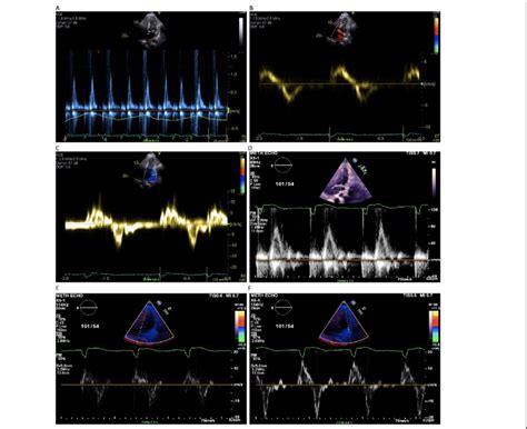 Mitral Inflow And Tissue Doppler Velocities Pre And Download