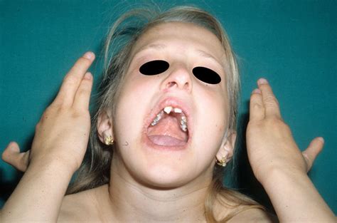 Vampiro Com Displasia Ectodermica Hipoidrotica 10 Pessoas Mais Feias