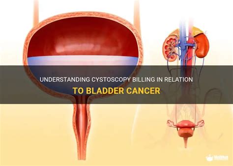 Understanding Cystoscopy Billing In Relation To Bladder Cancer Medshun