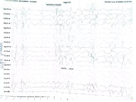 Abnormal Eeg Patterns Pptx