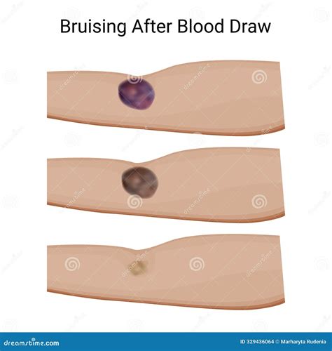 Bruise Stages Diagram Medical Science Vector Illustration
