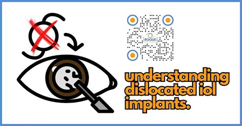 Understanding Dislocated Intraocular Lens Implants Causes Symptoms And Treatment Options