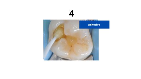 Your Guide To Back Tooth Cavity Filling Types Procedure And Aftercare