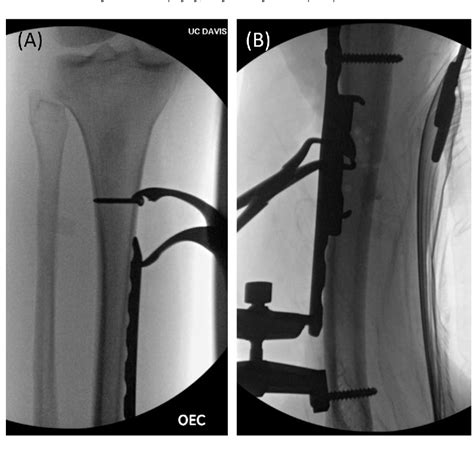 Figure 1 From Optimizing Compression Comparing Eccentric Plate Holes