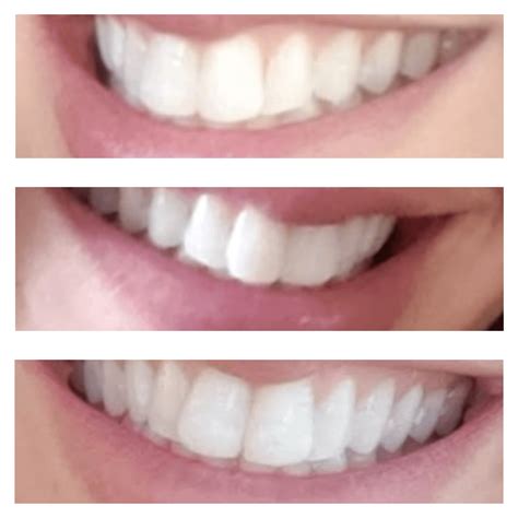 Botched Ipr Before Pics R Invisalign