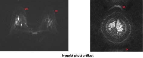 Nyquist Ghosting Nyquist Ghosting Mri Artifact