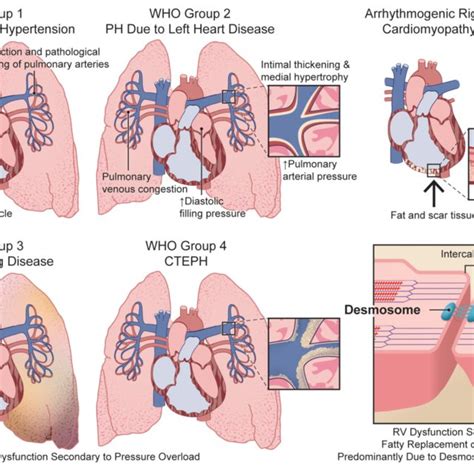 Comparison Of The Etiologies Of Right Ventricular Dysfunction In Download Scientific Diagram