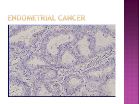 2 Carcinoma Endometrium Ppt