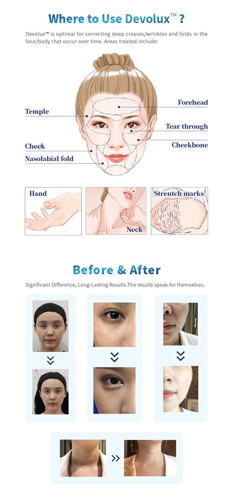 Devolux Plla Next Generation Injectable