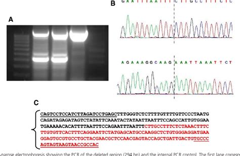 Figure 2 From Intragenic Gnas Deletion Involving Exon A B In Pseudohypoparathyroidism Type 1a