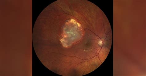 Girl Presents With Unilateral Retinal Lesion