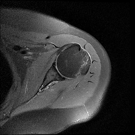 Humerus Greater Tuberosity Fracture X Ray At Evelyn Lawson Blog