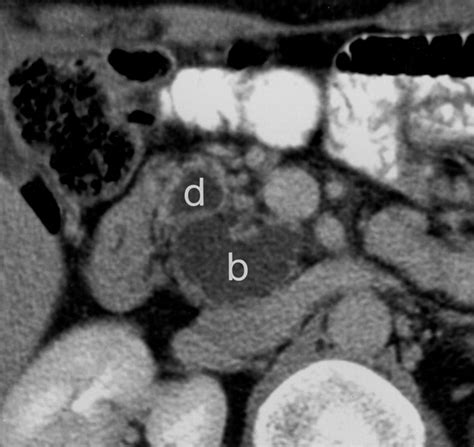 Making Sense of Mucin-Producing Pancreatic Tumors | AJR