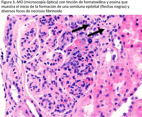 Nefropatía Membranosa Con Vasculitis Anca Negativa Sobreañadida