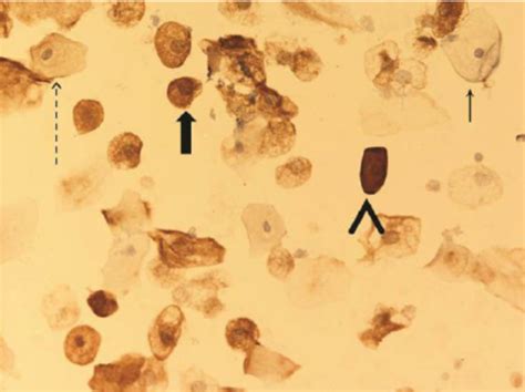 Examples Of Negative Weak Moderate And Strong Bax Antibody Staining