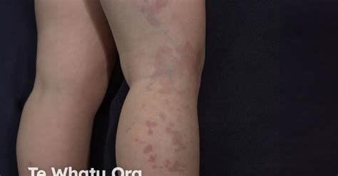 Vascular Malformation Image