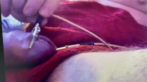 Electro On Balls And Foreskin
