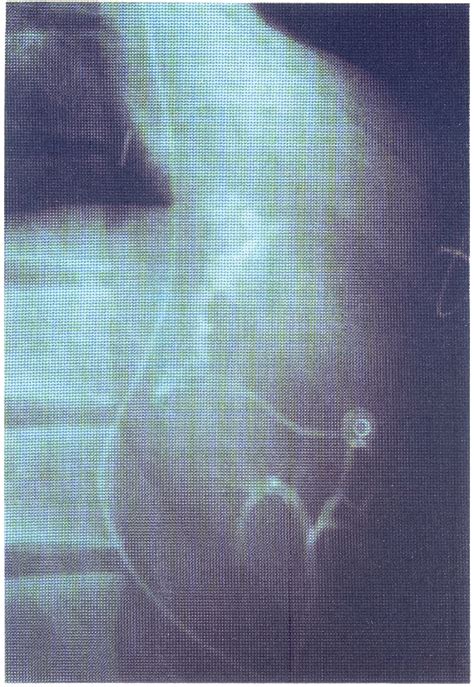 First Trans Nasobiliary Tube Cholangiography 5th Post Ercp Day The Download Scientific