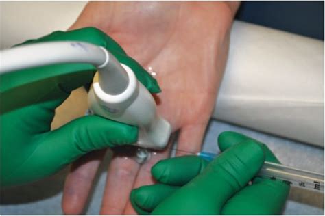 Trigger Finger Injection Wikism Sports Medicine Wiki