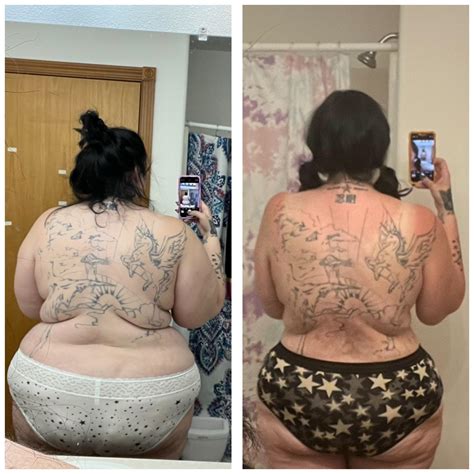 Progress R Gastricbypass