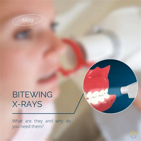 Bitewing X Rays What Are They And Why Do You Need Them