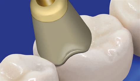 Bioclear Rs Rock Star Polishers Clinical Research Dental