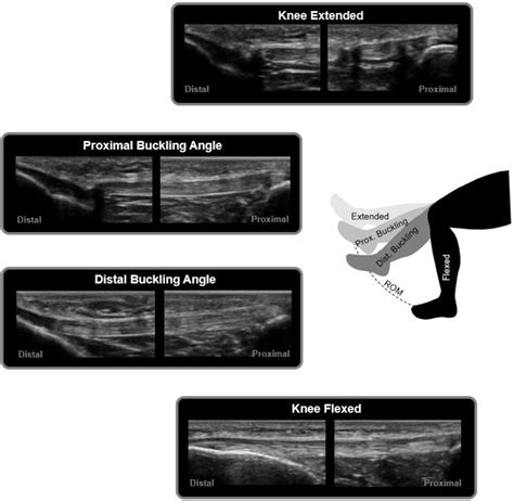 Figure 1 From Patellar Tendon Buckling Is Altered With Age Semantic