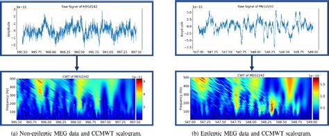 Figure 1 From Data Driven Model For Improving Meg Epileptic Spike Detection Semantic Scholar