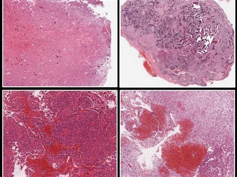 A Multi Class Brain Tumor Grading System Based On Histopathological