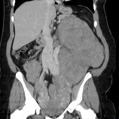 CT Scan Obtained At Presentation Coronal View Demonstrating A Mass Download Scientific Diagram