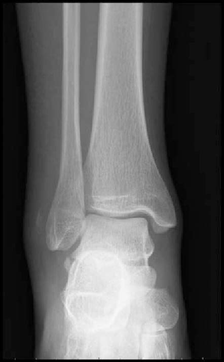 Figure 3 From Lateral Talar Process Fracture And Peroneal Tendon