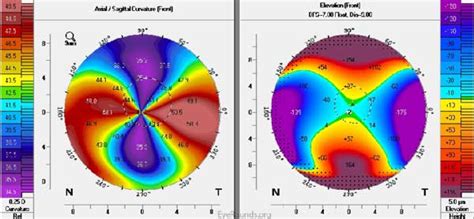 Atlas Entry Pellucid Marginal Degeneration