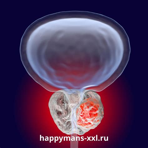 Профилактика простатита у мужчин