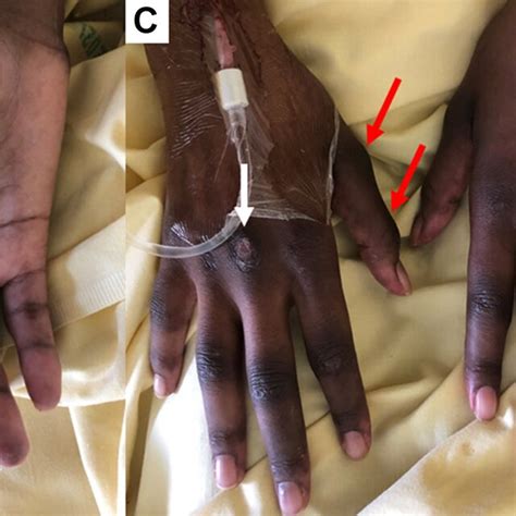 Cutaneous And Joint Manifestations Flagellate Hyperpigmentation On Download Scientific Cutaneous And Joint Manifestations Flagellate Hyperpigmentation On Download Scientific