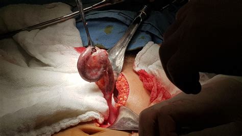 A Nice Babe Apendix R Surgery
