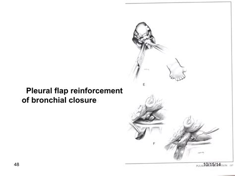 Pulmonary Resection Ppt